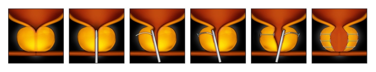 The UroLift® System for Treating Enlarged Prostate | Atlanta, GA