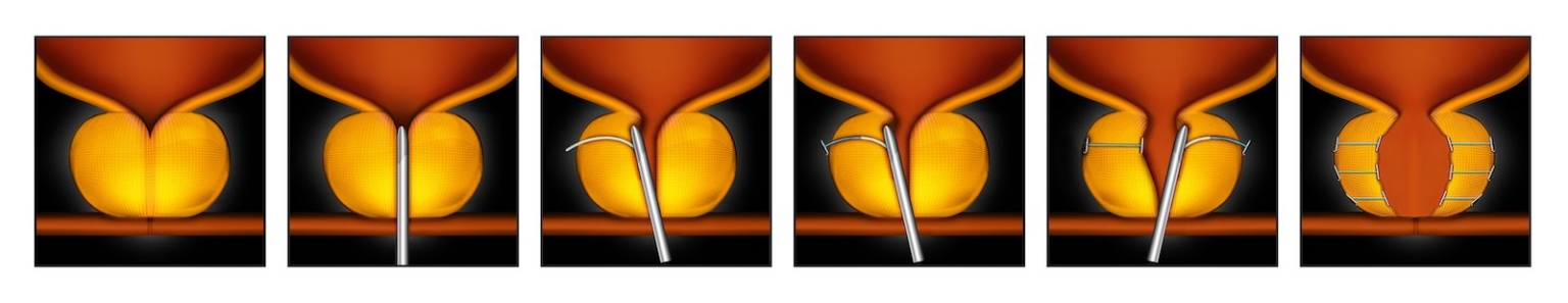 The UroLift® System for Treating Enlarged Prostate | Atlanta, GA