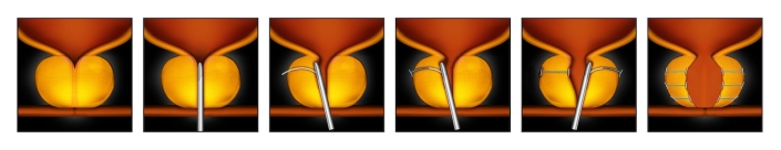 The UroLift® System for Treating Enlarged Prostate | Atlanta, GA