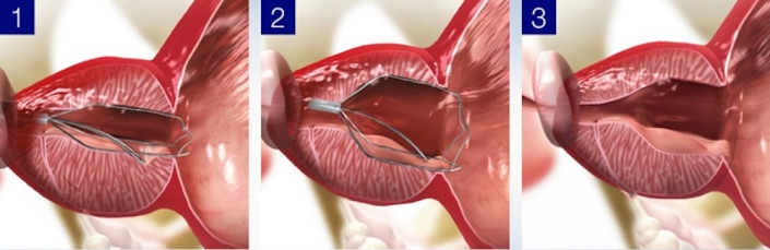 iTIND BPH (Enlarged Prostate) Therapy