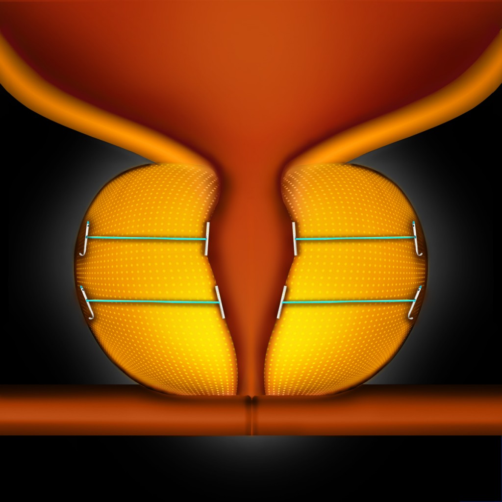 The UroLift® System for Treating Enlarged Prostate