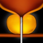 The UroLift® System for Treating Enlarged Prostate