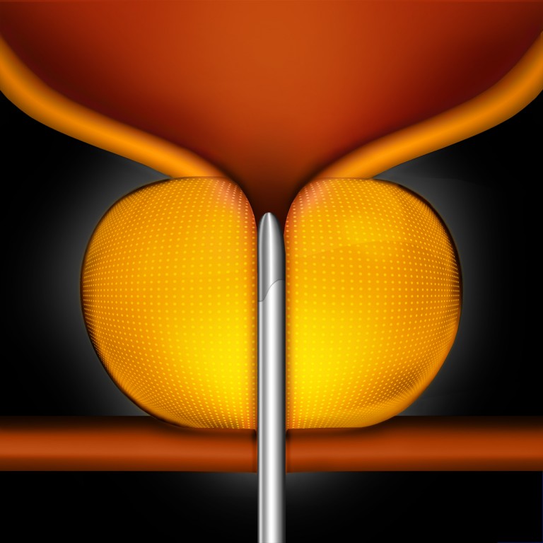 The UroLift® System for Treating Enlarged Prostate