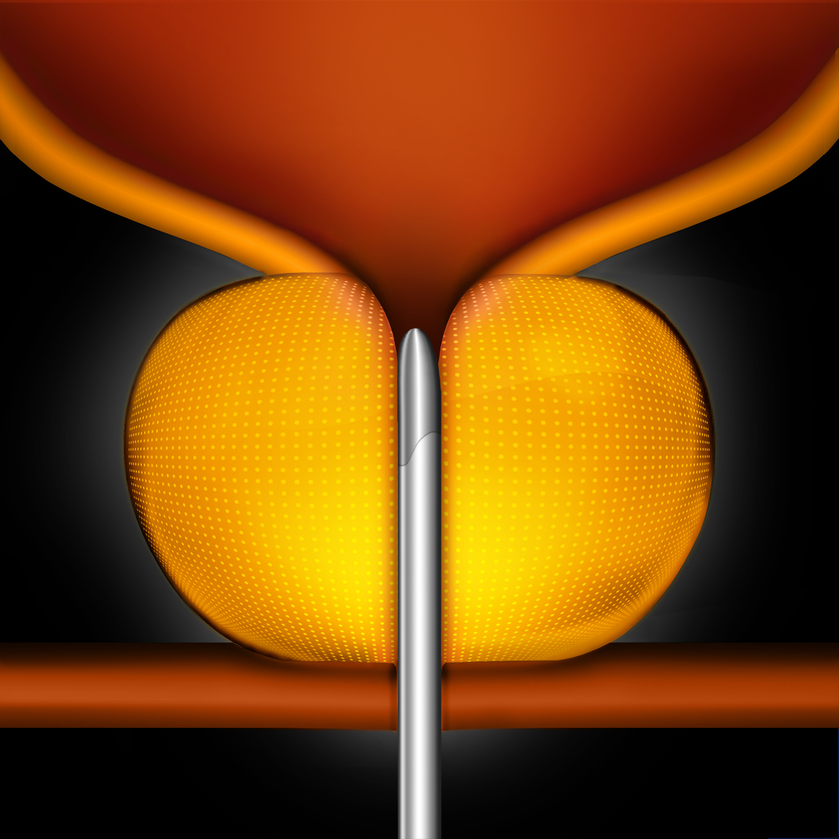 The UroLift® System for Treating Enlarged Prostate