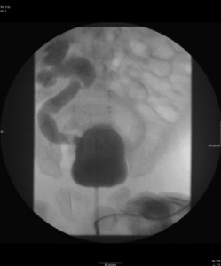 Pediatric Vesicoureteral Reflux (VUR) | Pediatric Urologists | Georgia ...