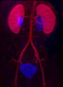 Pediatric Vesicoureteral Reflux (VUR) | Pediatric Urologists | Georgia ...